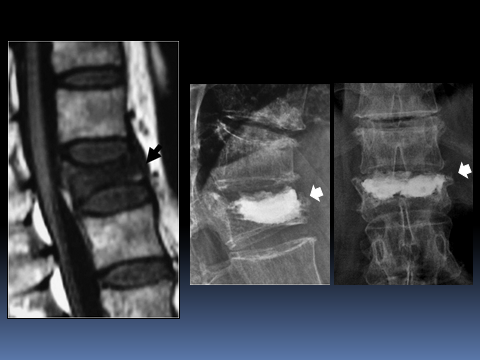 Fratture Vertebrali Osteoporotiche | Neuro Ortho-Spine and Pain Institute